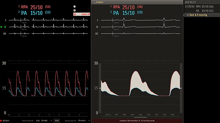 Congenital Heart Disease Interventions | Philips Healthcare