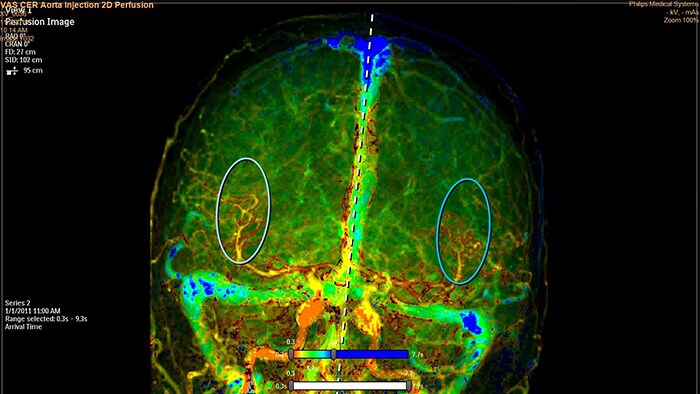 Image-guided neurosurgery | Hybrid OR | Philips Healthcare