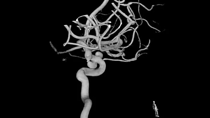 Cerebral aneurysm treatment | Philips