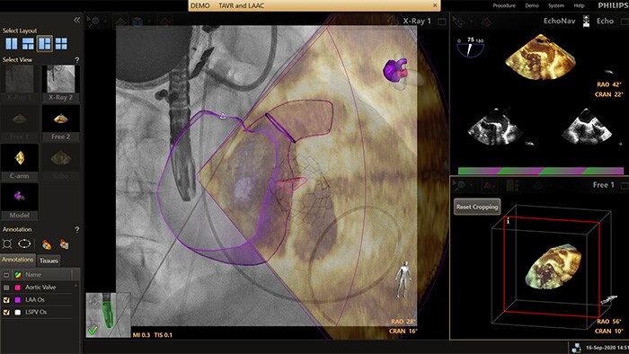 Left Atrial Appendage Occlusion (LAAO) | Philips