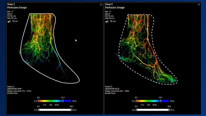 Peripheral arterial interventions | Philips Healthcare