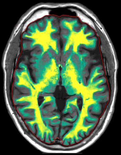 Philips SmartSpeed – MR Clinical Application | Philips