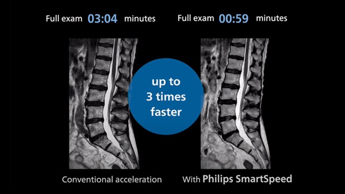 Philips SmartSpeed – MR Clinical Application | Philips