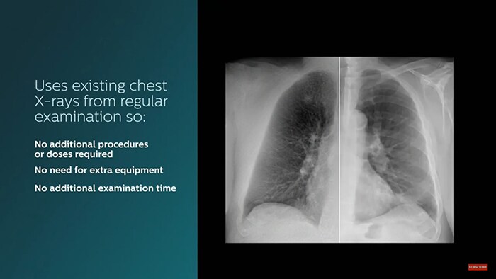 Bone Suppression | Philips Healthcare