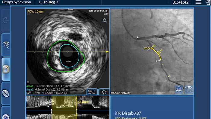 IntraSight Interventional Applications Platform | Philips