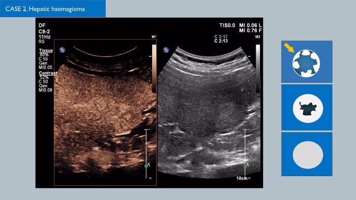 CEUS Contrast-Enhanced Ultrasound | Philips