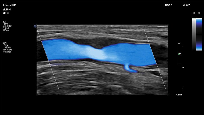Vascular Ultrasound System Portfolio | Philips