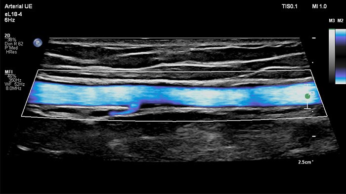 Vascular Ultrasound System Portfolio | Philips