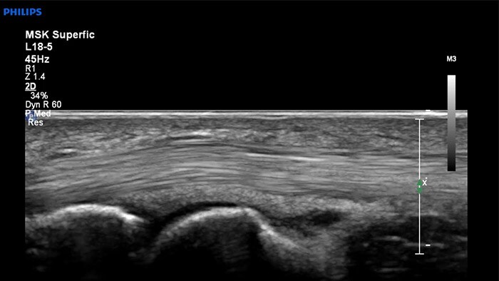 Musculoskeletal Ultrasound Resources | Philips Healthcare